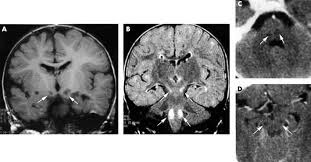 Medical Treatment Pictures-for Better Understanding: MELAS Syndrome