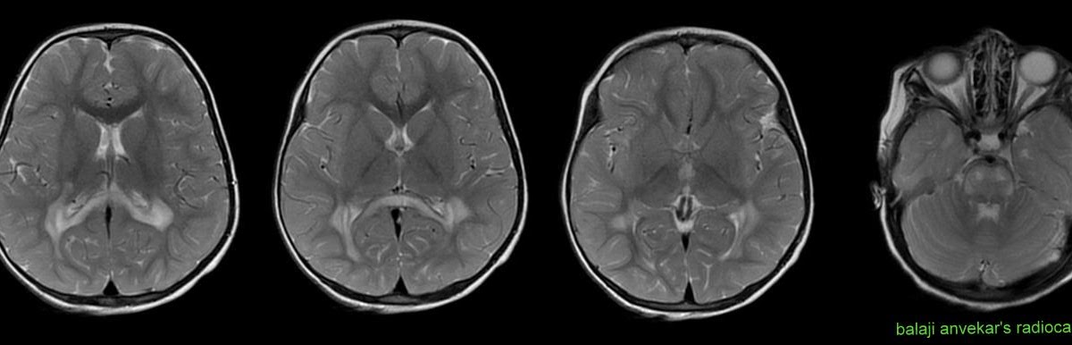 Dr Balaji Anvekar FRCR: Adrenoleukodystrophy MRI