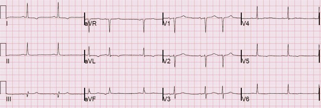 Dr. Smith's ECG Blog: "Inferior" ST depression: What is the diagnosis?