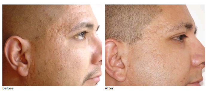 My Life: Dermaroller