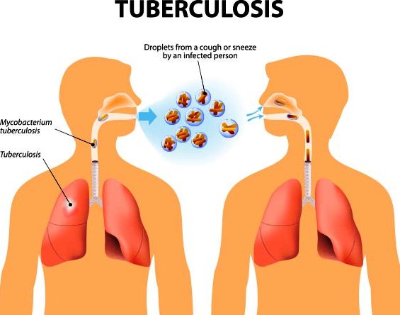How to create a healthy, balanced diet plan for TB patients - Health Info