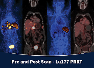 Nuclear Medicine Therapy for Cancer Treatment: Which Patients can ...