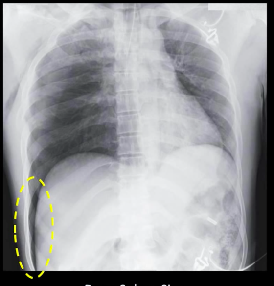 EM Didactic: Deep Sulcus Sign - Pneumothorax