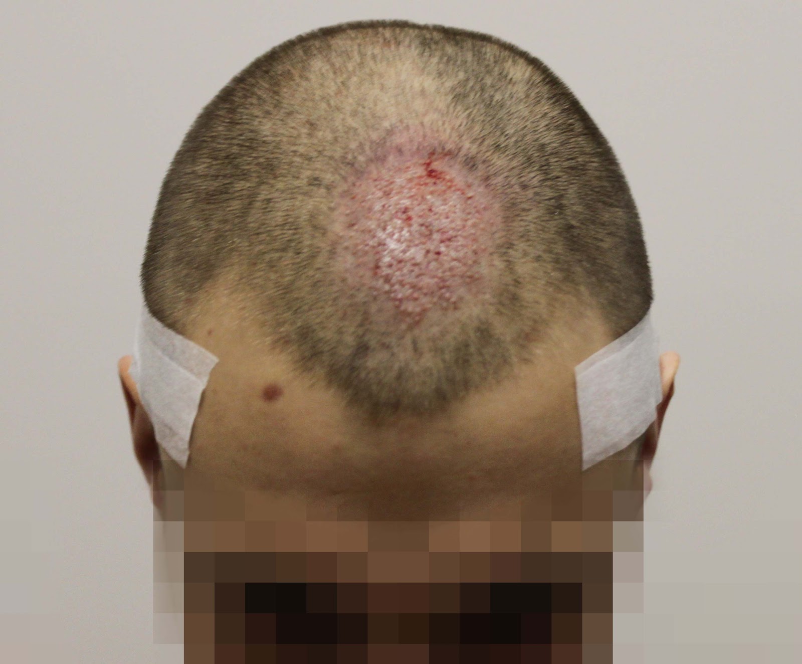 Selston Cosmetic Clinic: Diffuse Hair Loss....Before And After