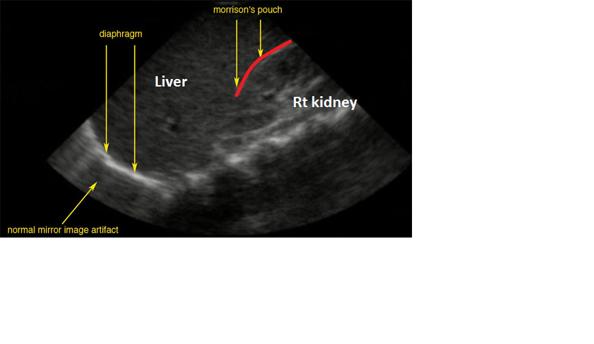 easyhumanatomy: Summary of Hepato-renal recess/ Pouch of Morison