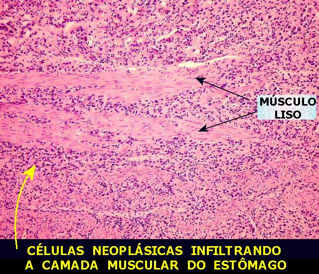 Atlas virtual de histologia e patologia: O QUE SÃO NEOPLASIAS?