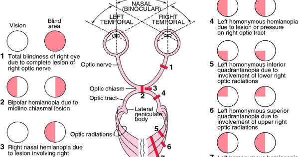 myneurologytips: Visual Field defects