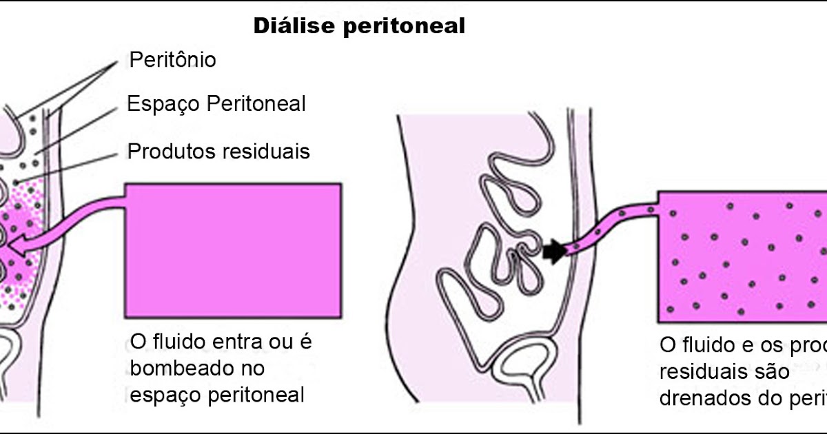 Vivendo a diálise peritoneal