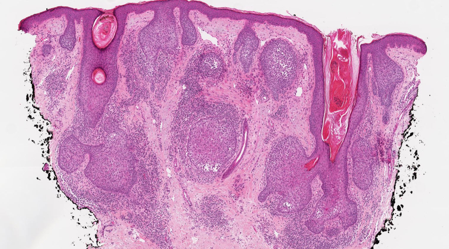 Differential Diagnosis in Dermatopathology: Follicular pathology