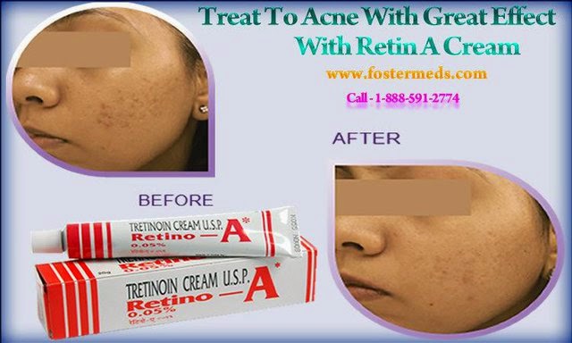 Nothing treats acne like retin-a cream
