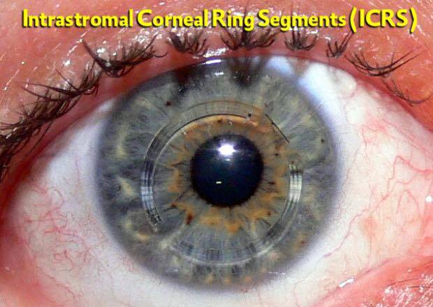 Ophthalmology Notes: Rings in ophthalmology