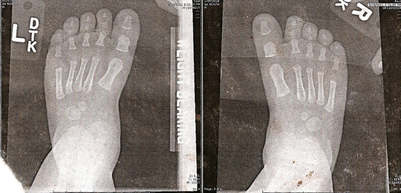 Xray Of Childs Foot