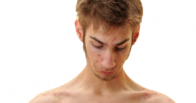 Acne En El Pecho - Causas y Remedios Para Eliminarlo - Tratamiento Para ...