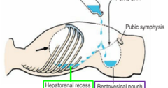 easyhumanatomy: Summary of Hepato-renal recess/ Pouch of Morison