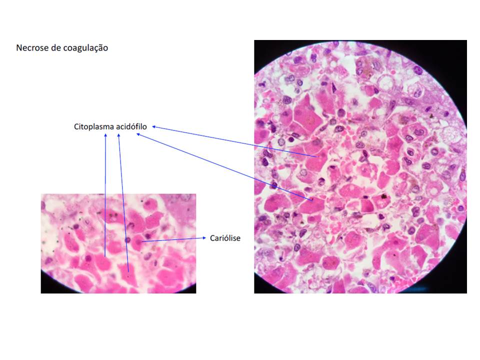 HISTOLOGIA90: TIPOS DE NECROSE