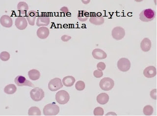 Alloimmune Hemolytic Anemia