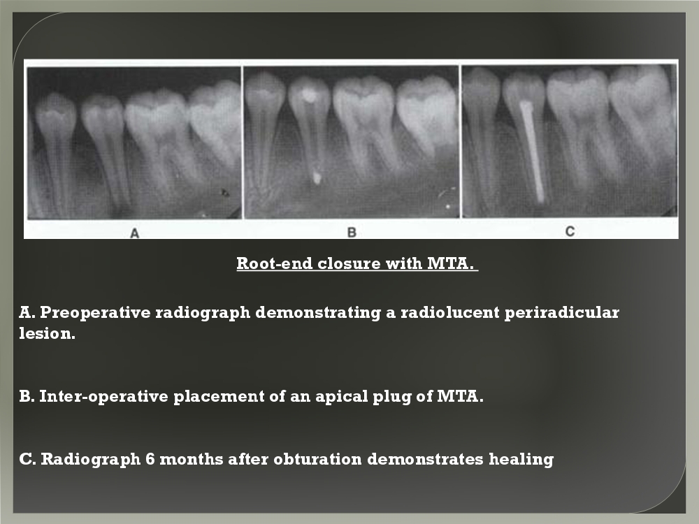 DOs and DONTs in DENTISTRY: MANAGEMENT OF INCOMPLETELY FORMED ROOTS
