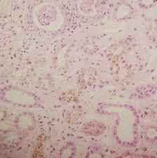 Medical Treatment Pictures-for Better Understanding: Hemosiderosis