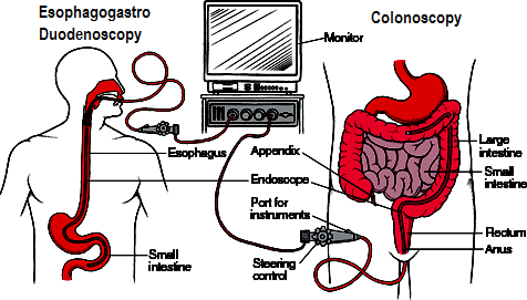 ENDOSCOPY Saluran Cerna | Info Kesehatan