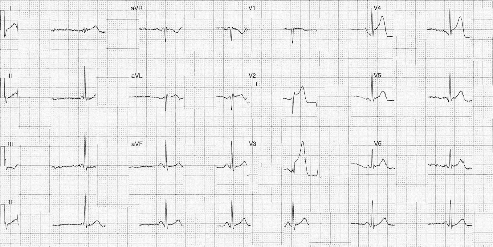 ECG of the Week: ECG of the Week - 2nd September 2013 - Interpretation