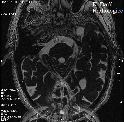 El Baúl Radiológico: ARTEFACTOS POR SUPERPOSICIÓN EN EL SENTIDO DE LA ...
