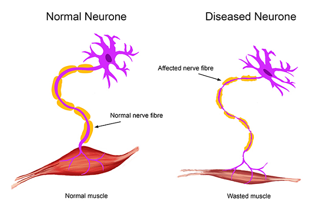 Motor neuron disease (MND)