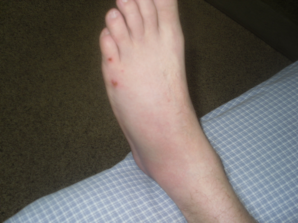 Darren and Ashley Sparks: Broken Foot