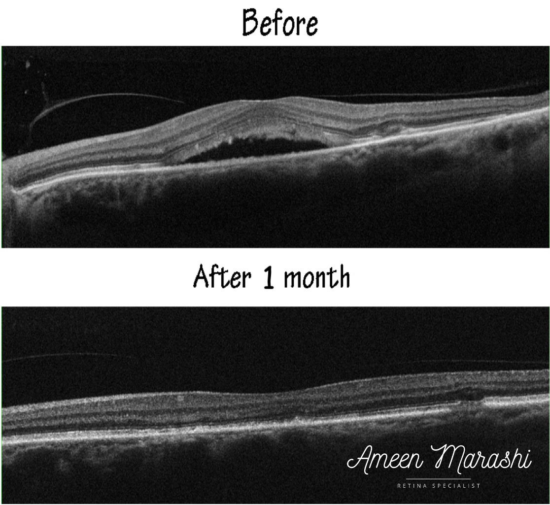 Central serous chorioretinopathy - Case report and Discussion