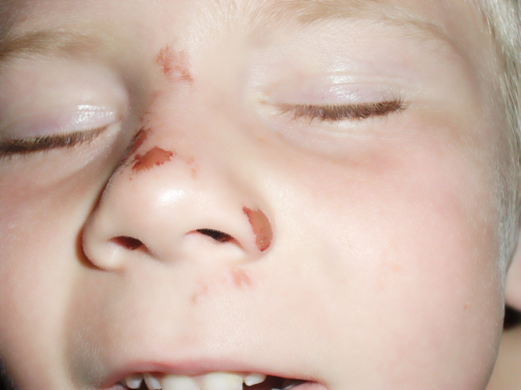 Road Rash.......and The Prickly Pear