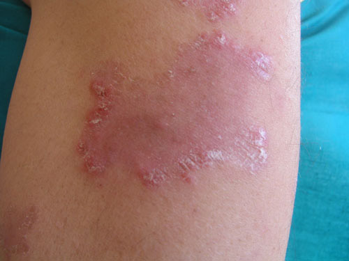 Manifestaciones De La Infección - Consejos de Salud