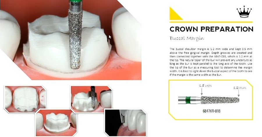 CROWN PREPARATION: General principles - Odonto-Tv
