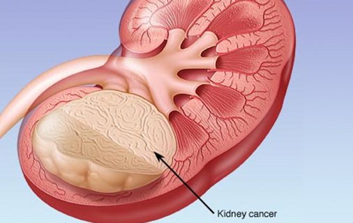 Complex Cyst On Kidney Cancer complex-cyst-on-kidney-cancer