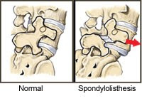 Spondylolisthesis (Part 1) | Growing Spine Blog | Washington University ...