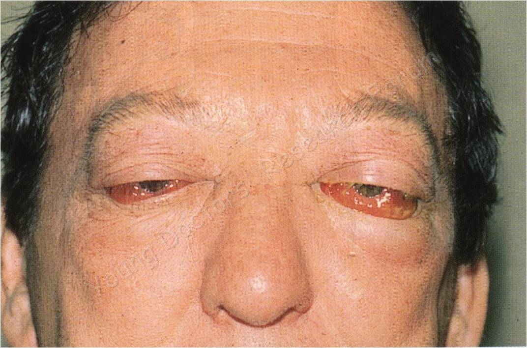 Common Eye Diseases Images ~ YOUNG DOCTORS' RESEARCH FORUM