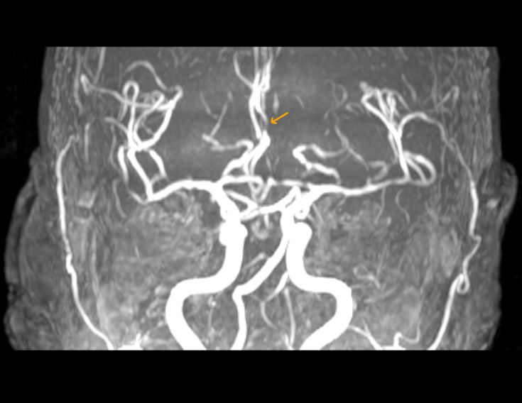 Corpus Callosum Infarction-MRI - Sumer's Radiology Blog