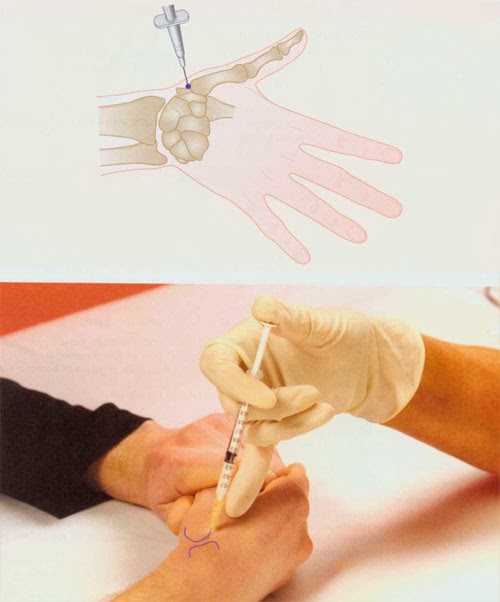 Thumb and Finger Joint Injection ~ Nursing