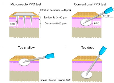Microneedle Patch - Painless TB Skin Test | iNVISIBLE YET iNVINCIBLE