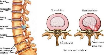 Badan Sihat Hati Ceria: Ikhtiar dengan Resveratrol, Slipped Disc ...