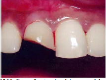 Tooth Fractures - Endodontics and Oral Implantology
