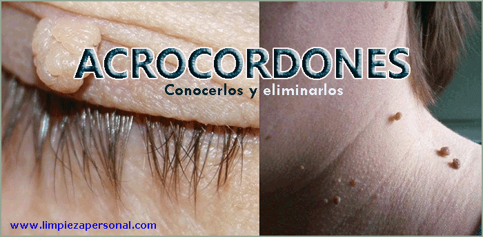 ACROCORDONES O LUNARES DE RELIEVE - LIMPIEZA E HIGIENE PERSONAL