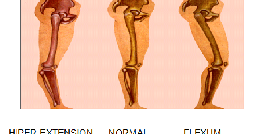 FISIOTERAPIA EN LA SOCIEDAD: RECURVATUM