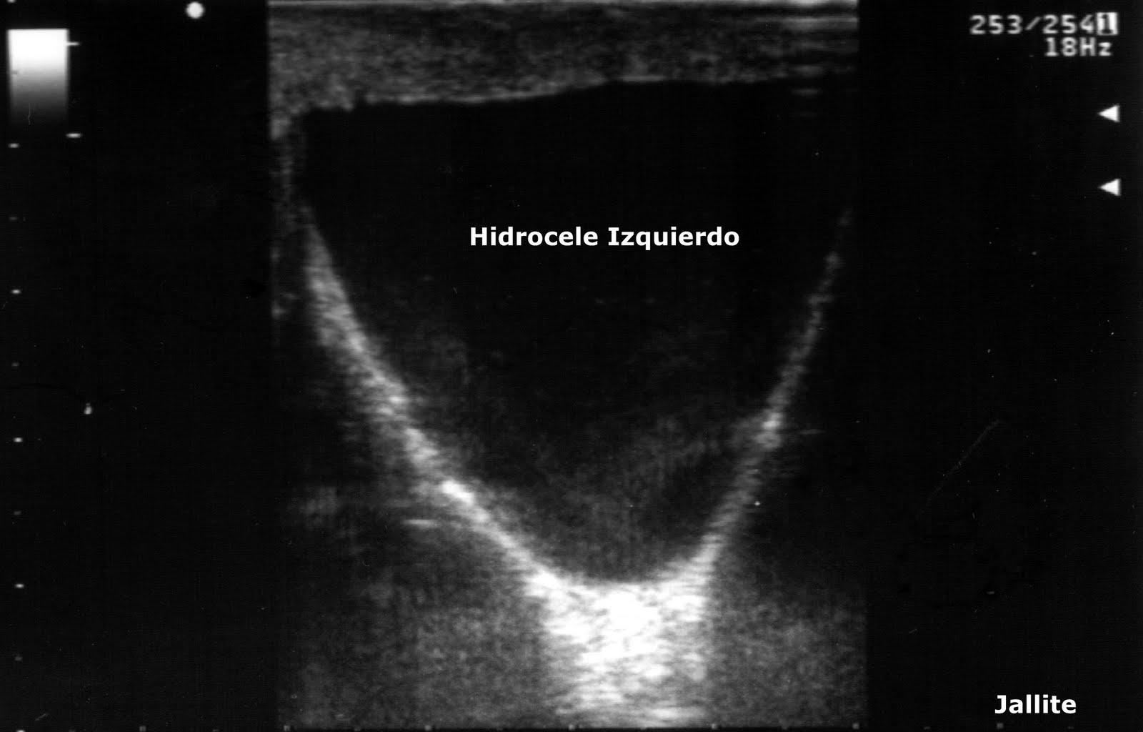 Hidrocele & Epididimitis
