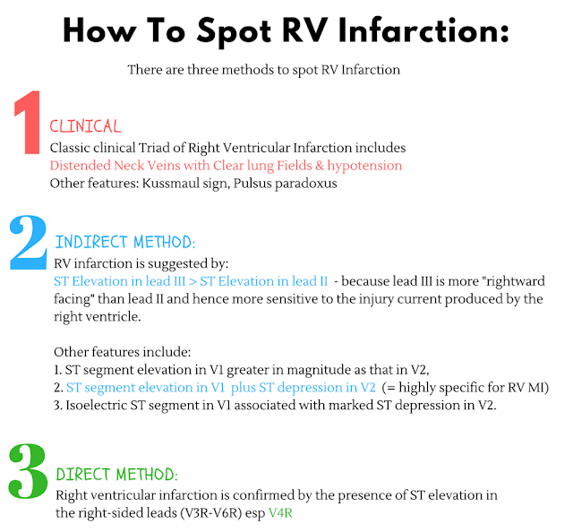How To Spot Right Ventricular (RV) Infarction on ECG