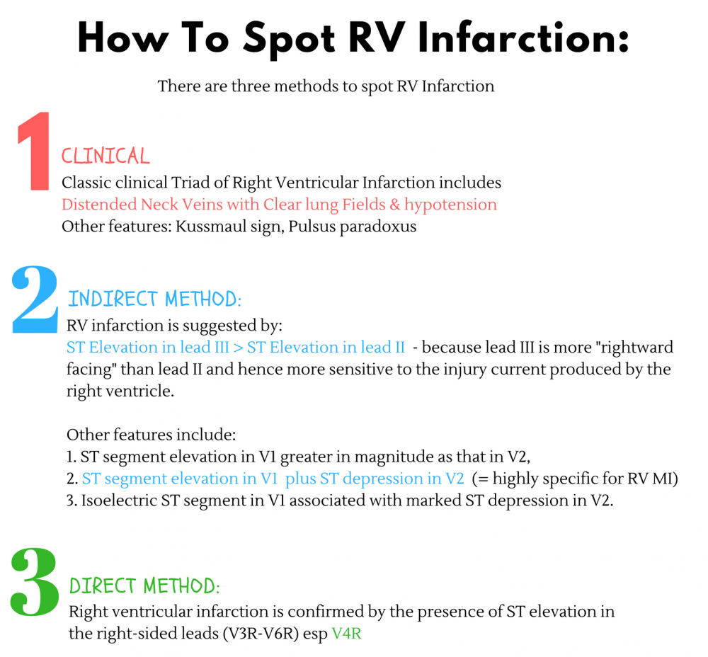 How To Spot Right Ventricular (RV) Infarction on ECG