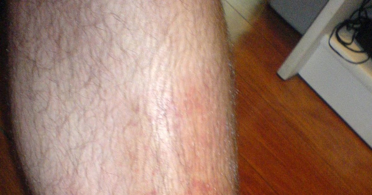 Fitness instructions: Effect of steroid on skin