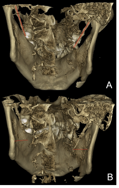 CIDEM: APÓFISIS ESTILOIDES ELONGADA