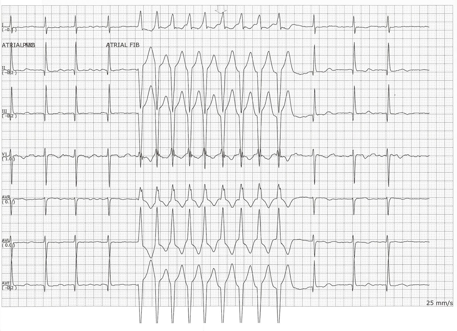 Atrial fibrillation with a Short Run of VT