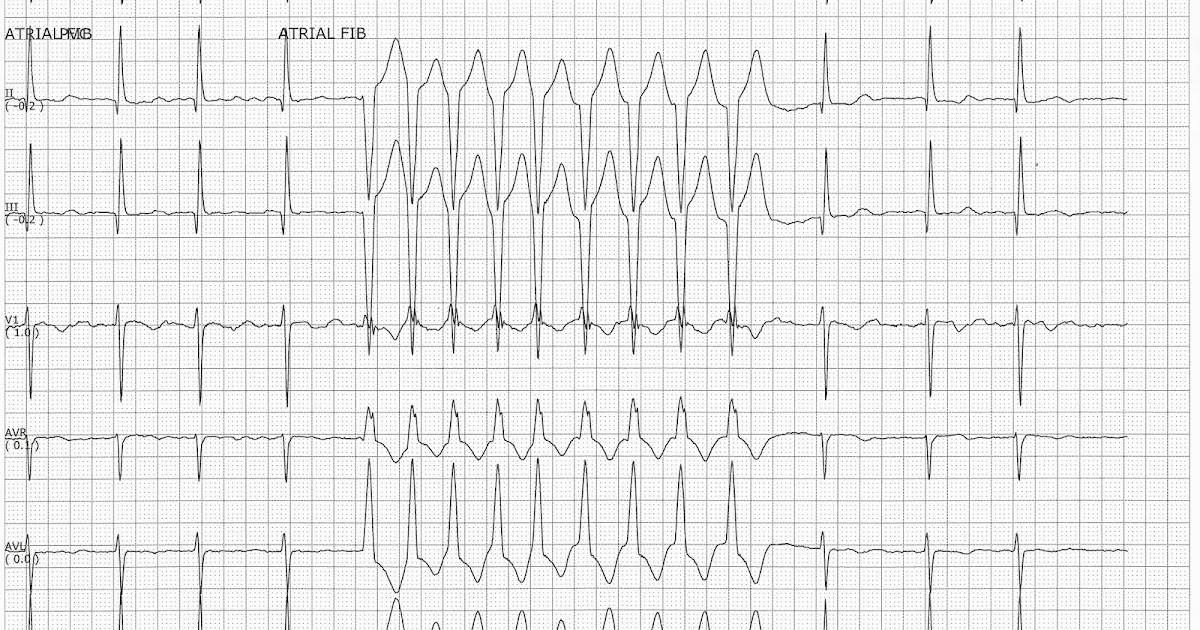 Atrial fibrillation with a Short Run of VT