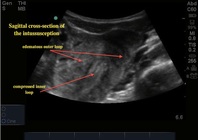 Intussusception