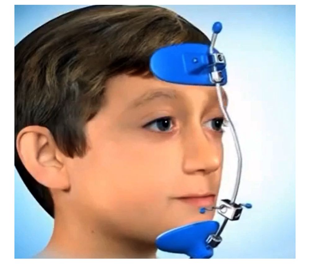 Tratamiento de la maloclusión Clase III con protracción maxilar ...